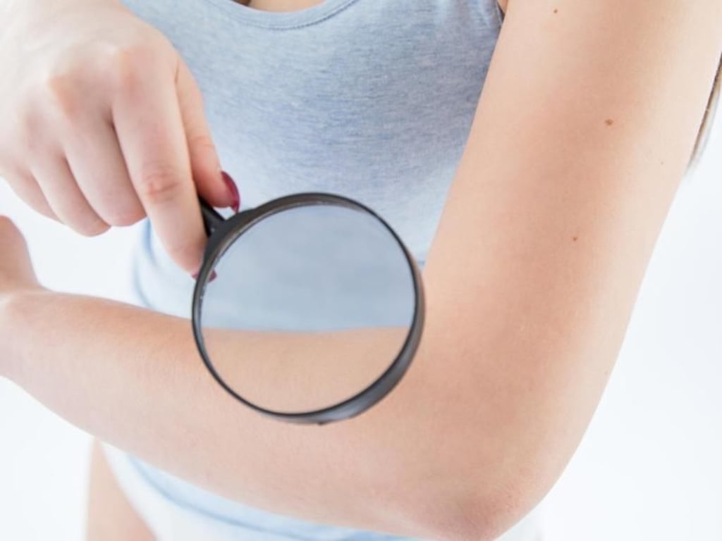 Nicht jeder Leberfleck ist harmlos