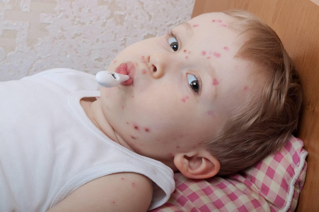 Windpocken wieder auf dem Vormarsch